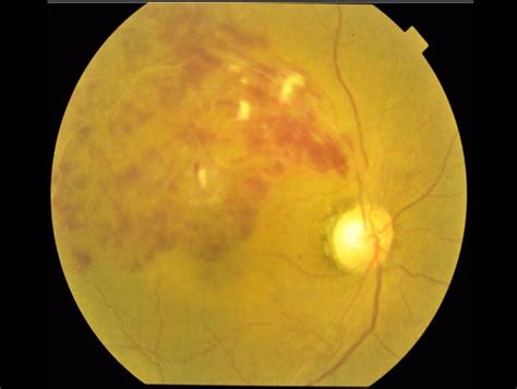 Cotton Ball Eye Test At Martha Brugger Blog