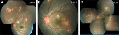 Full Article Clinical Experience In Treatment Of Diffuse Unilateral