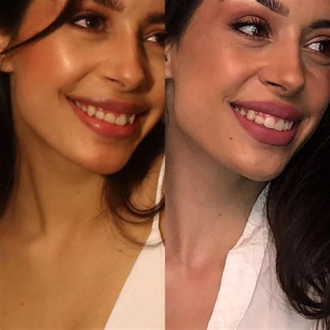 Can Finally See My Left Lateral Incisor When I Smile Tray 1316