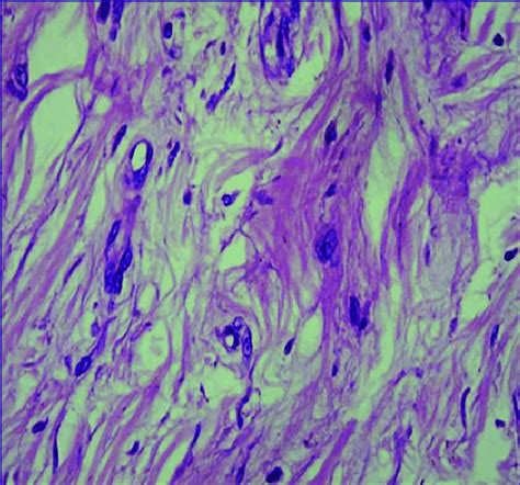 Photomicrograph Of Tumor Mass Showing Few Bizzare Cells Hande 40x