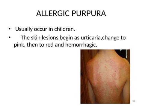 Bleeding Disorders Classification Vascular Abnormalities Pptx