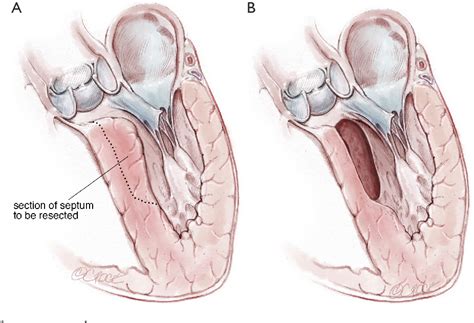 Figure 3 From Transaortic Septal Myectomy Techniques And Pitfalls