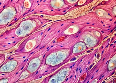 Histological Analysis Of Aboveknee Amputation Specimen Revealing