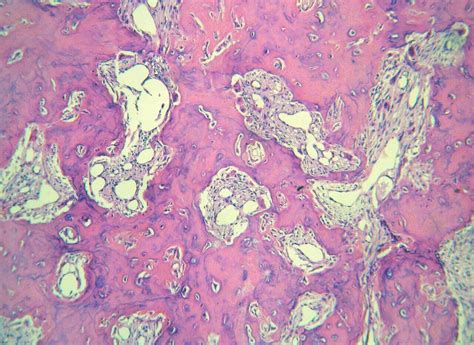 Cementoblastoma Histology