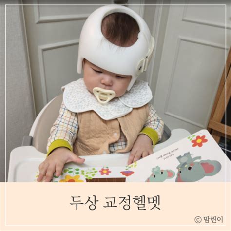 신생아 두상 교정 아기 사두증 치료 두상교정헬멧 모자 시기 오쏘코리아 네이버 블로그