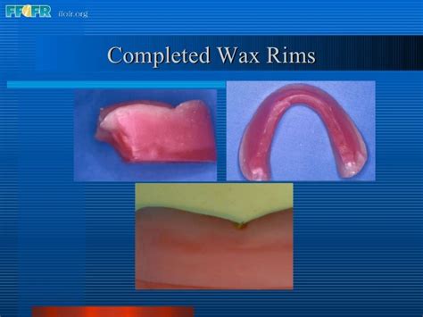 Dental Wax Rims At Virginia Lyman Blog