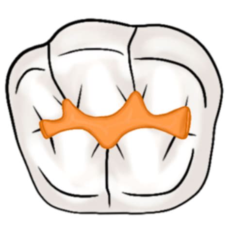 Amalgam My Dental Key