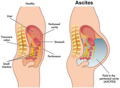 Causes Of Ascites Medizzy