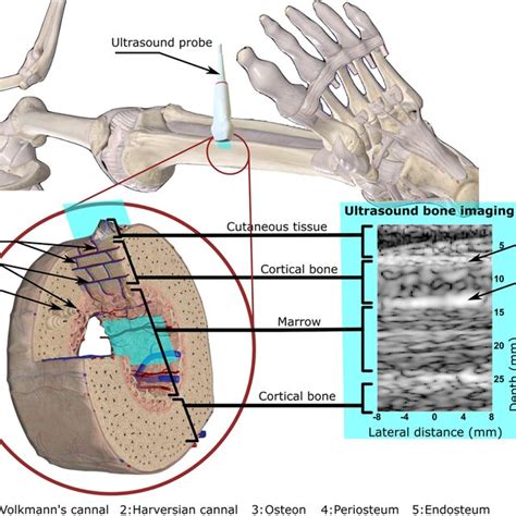 Ultrasound Imaging Of The Bone Cortex At The Tibia This Figure Shows A