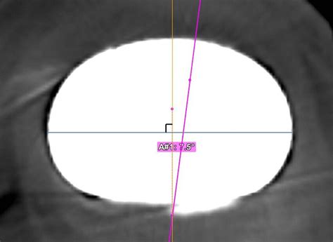 The Tibial Component Axis Is Defined As The Line Perpendicular To The Download Scientific