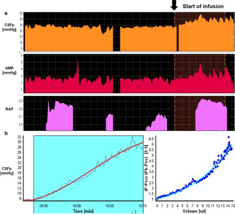 Representative Example Of A CSF Infusion Study And Analysis Of CSF Download Scientific Diagram