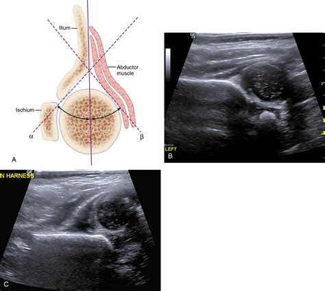 Congenital And Developmental Abnormalities Of The Hip And Pelvis