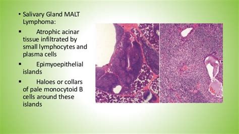 Malt Lymphoma Of Lungs Prognosis Rqrr