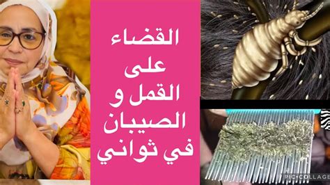 علاج القمل و الصيبان نهائيا و سريعا و عدم رجوعه ابدا وصفة سوف تنهي القمل الى الابد Youtube