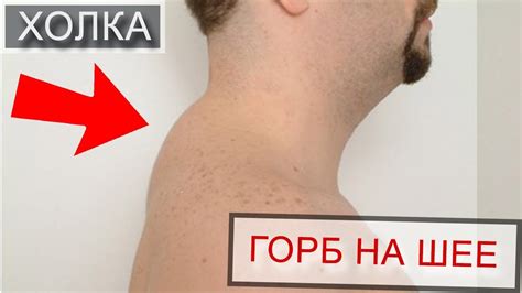 Холка на шее вдовий горбик гормональный горбик климактерический эстетический Радион