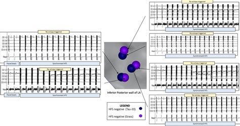 Reproducibility Of Hfs Negative Sites With Synchronised Hfs Using The Download Scientific