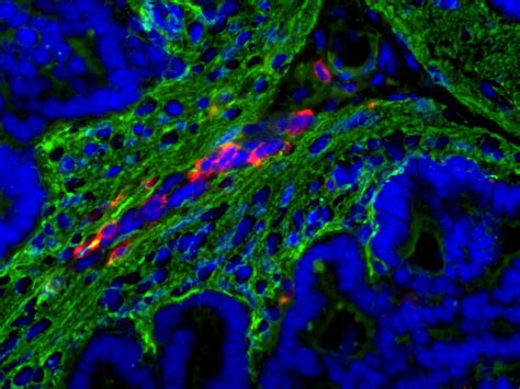 Detecting Prostate Cancer Why We Need More Research Cancer Research Uk Cancer News