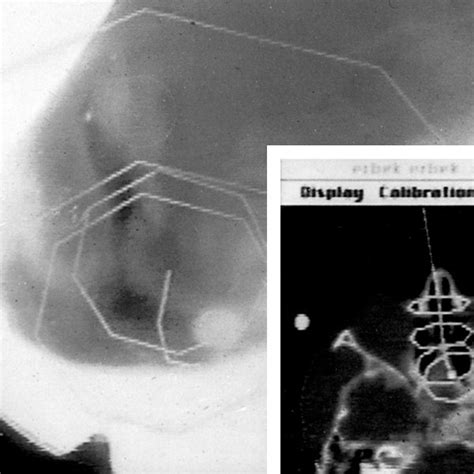 Endonasal Endoscopic Decompression Of The Orbit And The Optic Nerve Download Scientific Diagram
