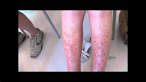 Sun Allergy Legs How To Get Rid Of Heat Rash Quickly