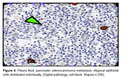 Cellular And Molecular Biology The Contribution Of Cell Block Method To Histopathological And