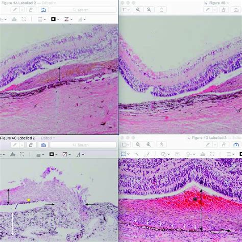 Histopathology Of Type 2 Choroidal Neovascularization Cnv A A Download Scientific Diagram