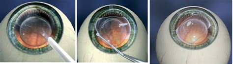 Implantable Collamer Lenses Icls What To Know