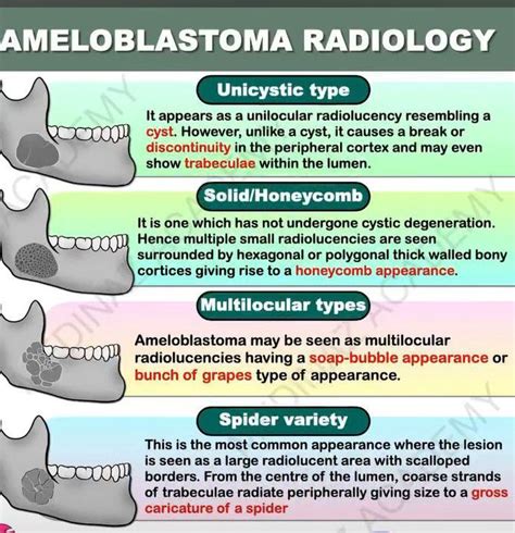 Ameloblastoma Radiology Medizzy