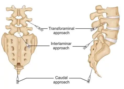 Transforaminal Epidural Steroid Injections Tfesi Altoona Pa
