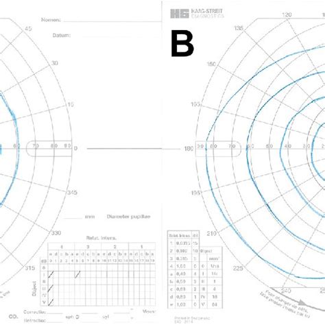 Goldmann Visual Field Test In Left Eye A Central Scotoma Isopter