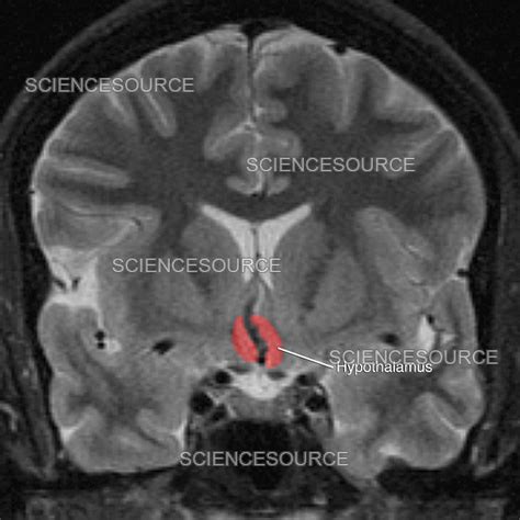 Hypothalamus Mri