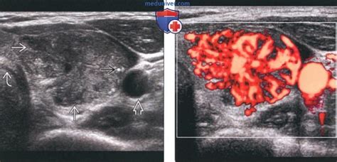 УЗИ при дифференцированном раке щитовидной железы