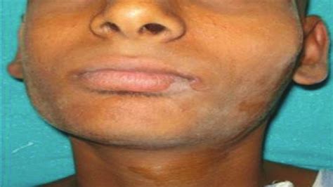 Unilateral Coronoid Hyperplasia Treated By Coronoidectomy Us National Journal Of