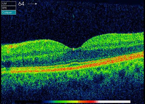 Glaucoma Care — Vision North Boston Comprehensive Eye Care