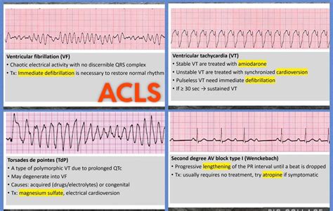 10 Must Know Ecg Rhythms For Acls Training Rfoamed911