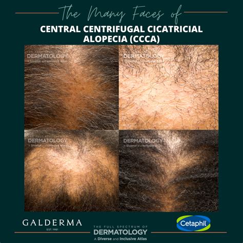 Central Centrifugal Cicatricial Alopecia Ccca Archives Next Steps