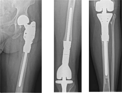 Radiographs Of Proximal Femur Tumor Arthroplasty Cemented Zimmer
