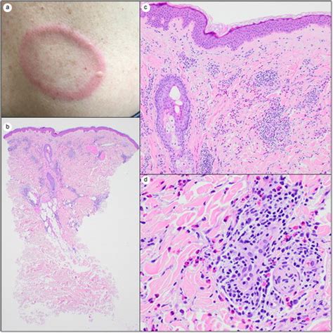 Erythema Annulare Centrifugum Histology