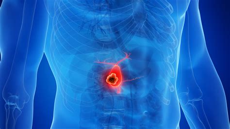 Novel Biomarkers May Improve Diagnosis Of Gallbladder Cancer The Asco
