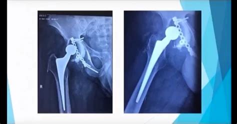 Revision Thr For Acetabular Component Loosening —