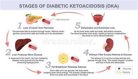 Stages Of Diabetic Ketoacidosis Dka Stock Illustration Illustration Of Diabetes Diabetic