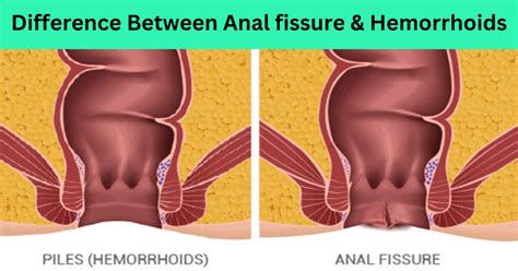 Anal Fissure Vs Hemorrhoids 3 Main Symptoms To Differentiate Easily