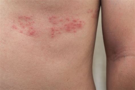 What Herpes Looks Like Pictures Prevention Treatment