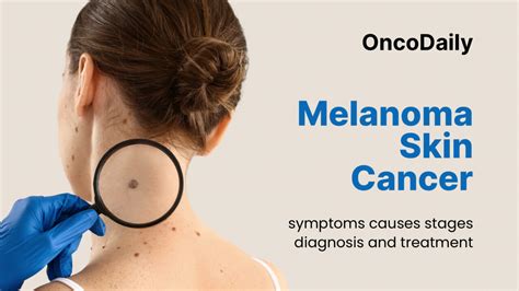 Melanoma Skin Cancer Symptoms And Causes Stages Diagnosis And Treatment