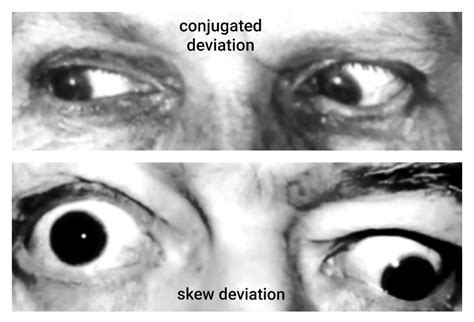 Eye Deviation In Strokes Can Be Helpful In Facebook
