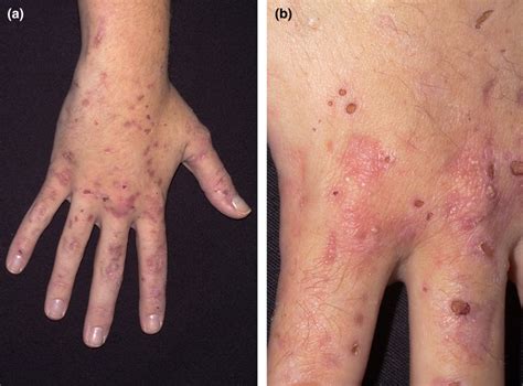 Cutaneous Porphyrias Part I Epidemiology Pathogenesis Presentation