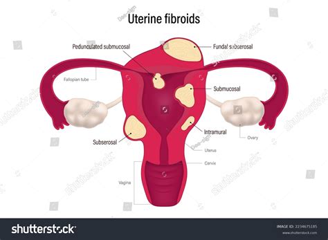 Fundal Subserosal Photos Images And Pictures Shutterstock