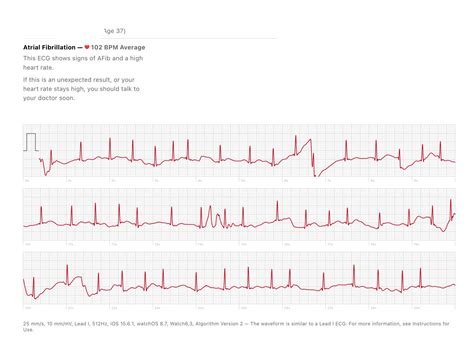 History Of Avnrt Pacs Afib R Readmyecg