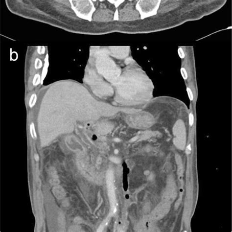 Nonenhanced Ct At Admission Showed Extensive Thrombophlebitis Of The
