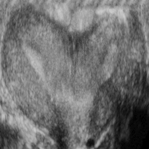Gyn Ultrasound Abnormal Ultrasounds Images Fetal Anomalies Of The