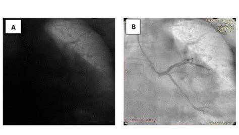 Effective Spatio Temporal Filtering For Progressive Radiation Dose Reduction In Cardiac Imaging